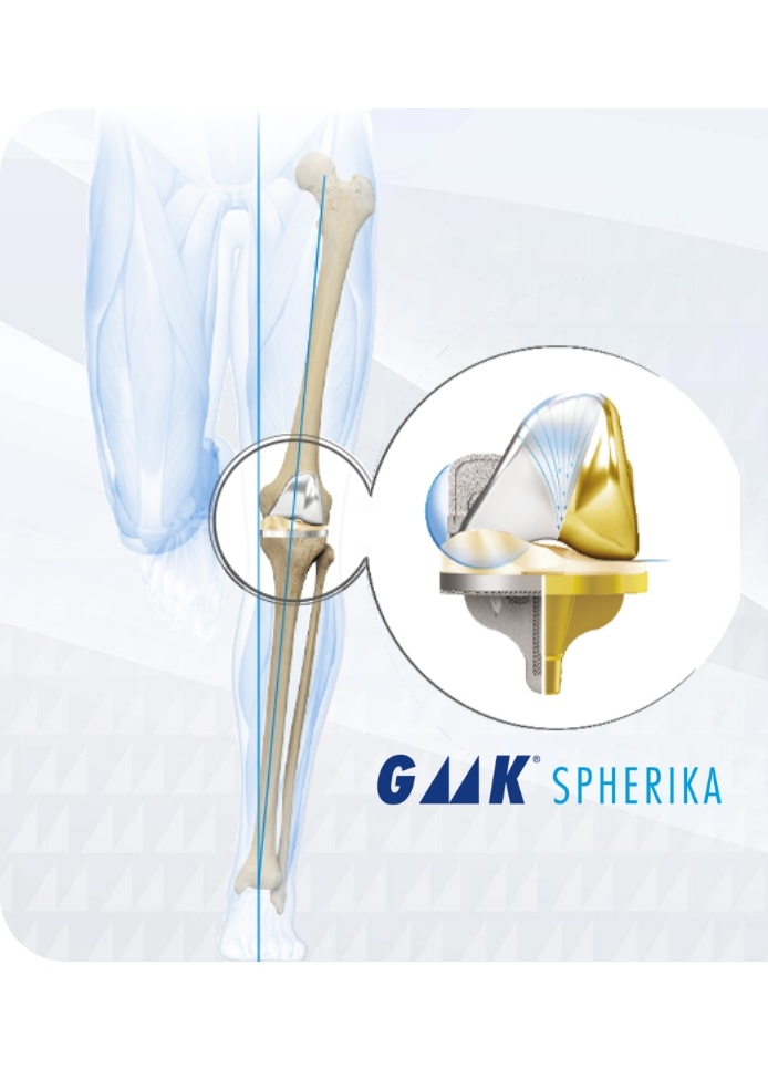 Webinar | Why kinematic alignment for knee replacement?